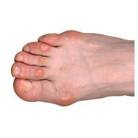 Ligtorne | Alt om: Behandling og forebyggelse | Med24.dk